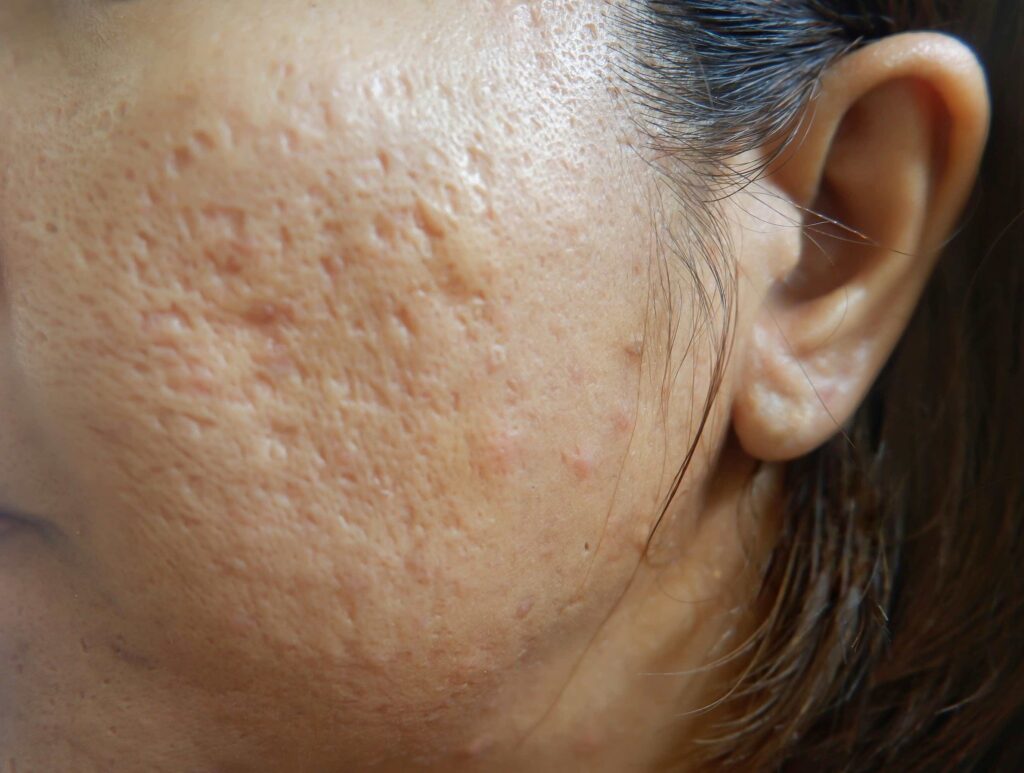 Aknearr - Få behandling for uønsket aknearr | Stavanger Kosmetiske